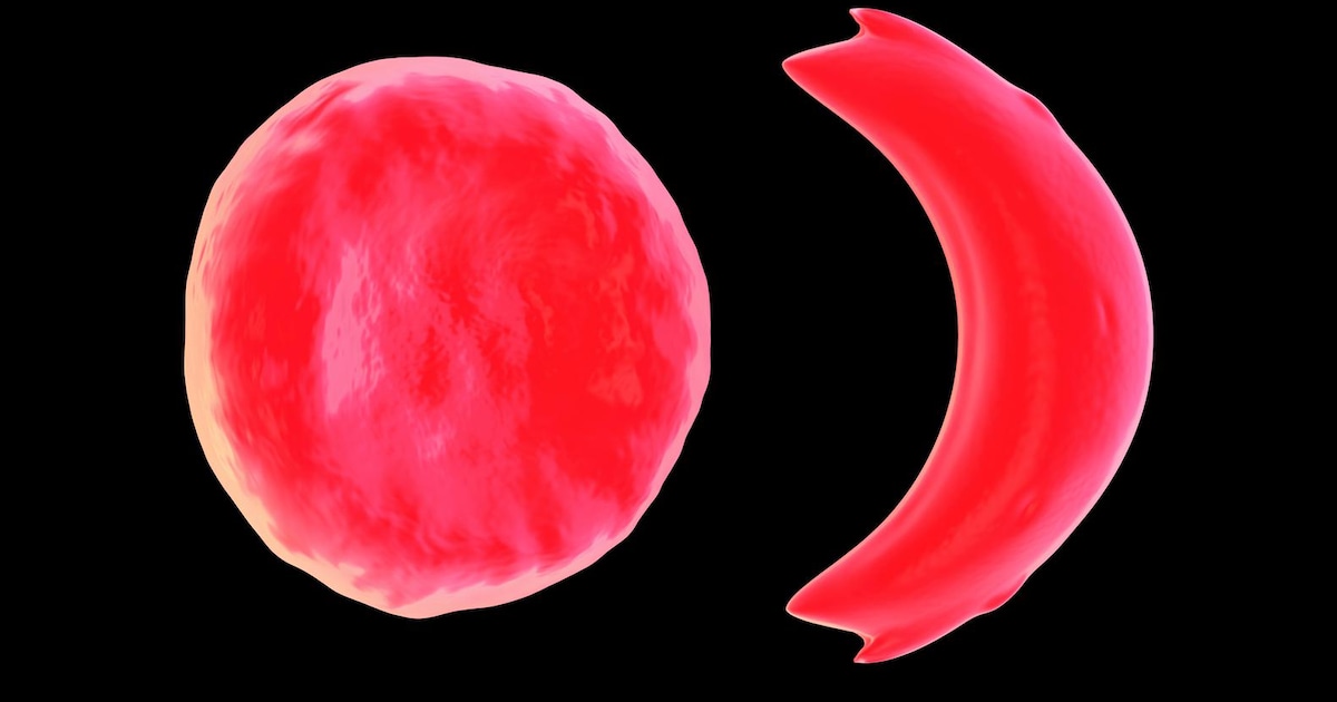 Succesvolle gentherapie is gamechanger in behandeling van beruchte ...