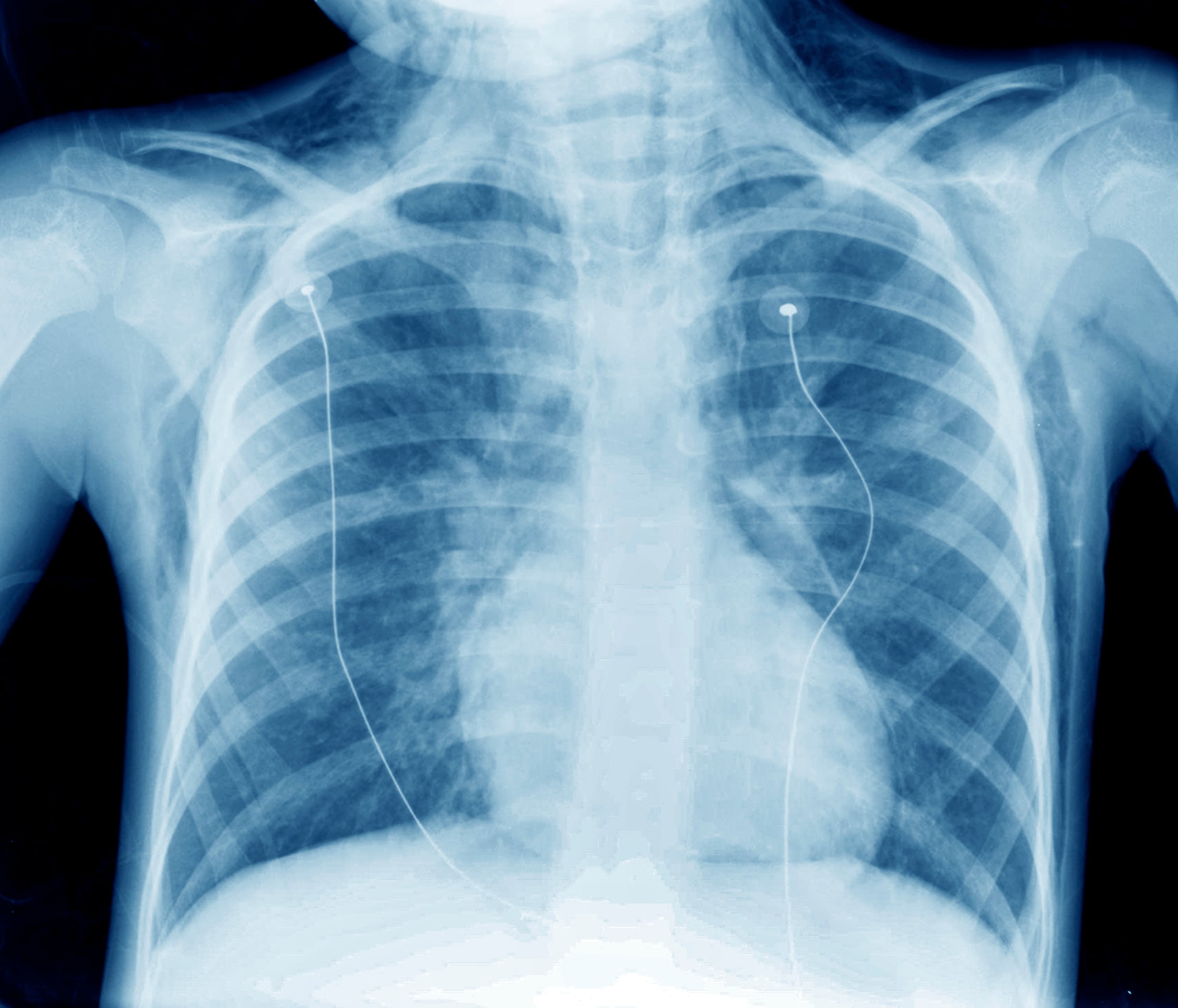 Computerprogramma's kunnen röntgenfoto's lezen - welkome ontwikkeling ...