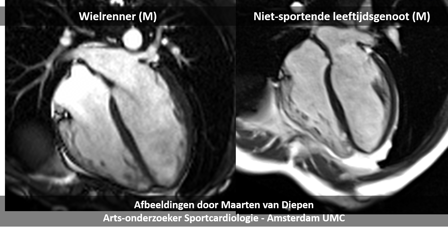 Functioneert het hart aantoonbaar slechter door wielrennen? Cardioloog ...