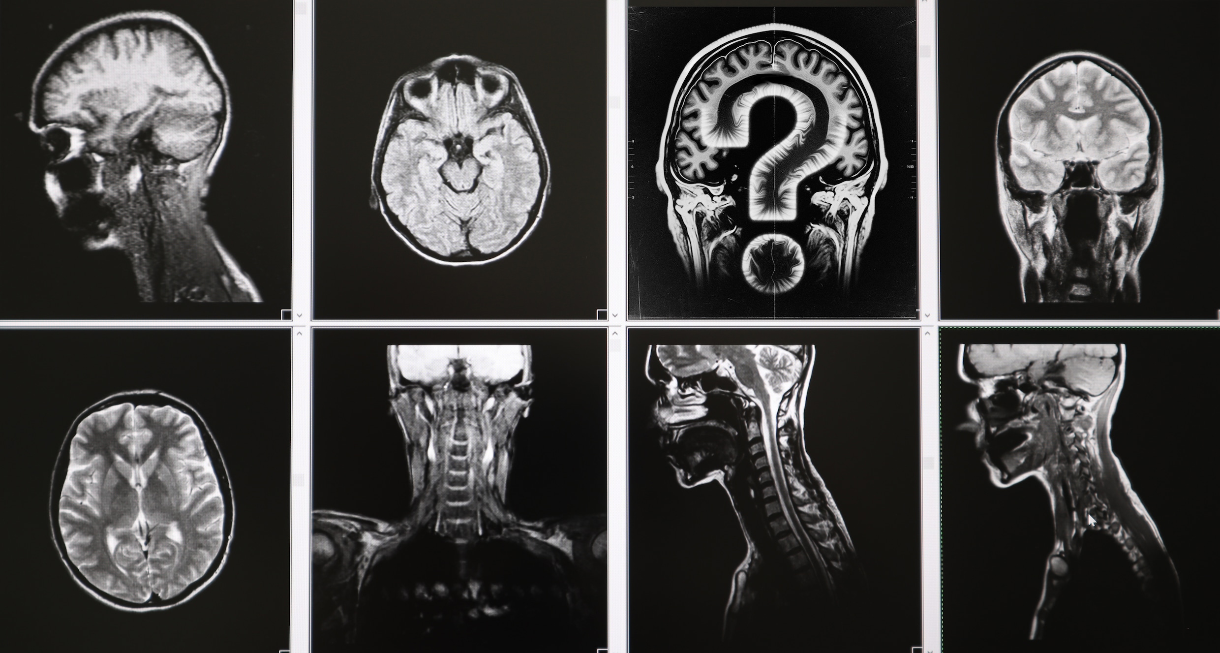 Een hersenscan ‘ter geruststelling’ kan een recept voor onzekerheid ...