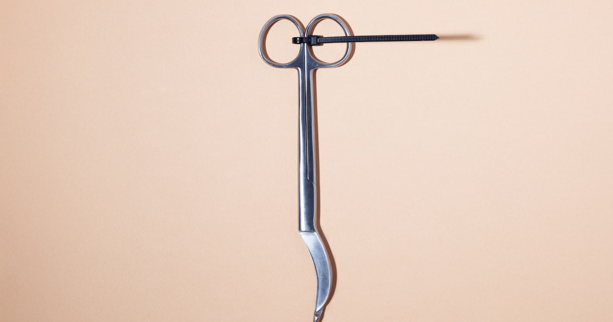Tienduizenden vrouwen per jaar bevallen met een ‘knip’, maar is dat ...